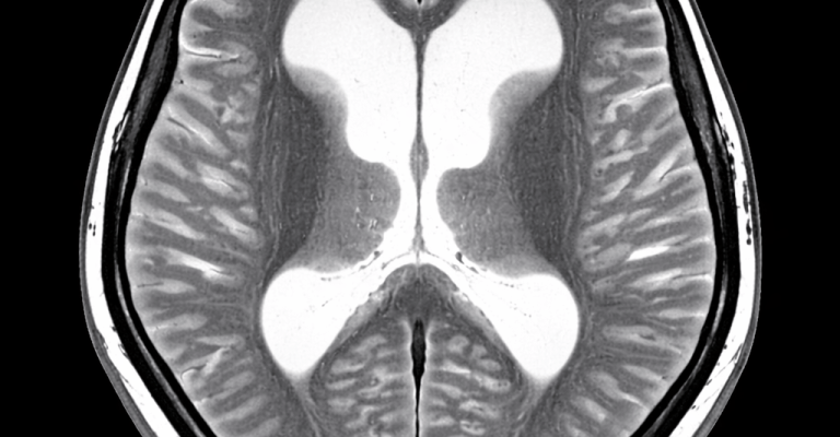 Hydrocéphalie | GHU Paris psychiatrie & neurosciences