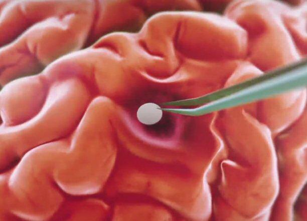 La chimiothérapie intra-cérébrale : implants de Carmustine | GHU Paris ...